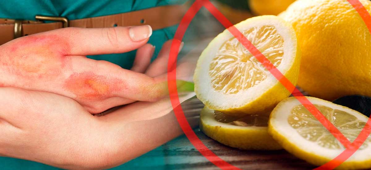 Remedios caseros para las quemaduras