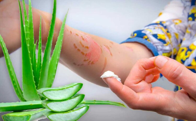 Remedios caseros para las quemaduras